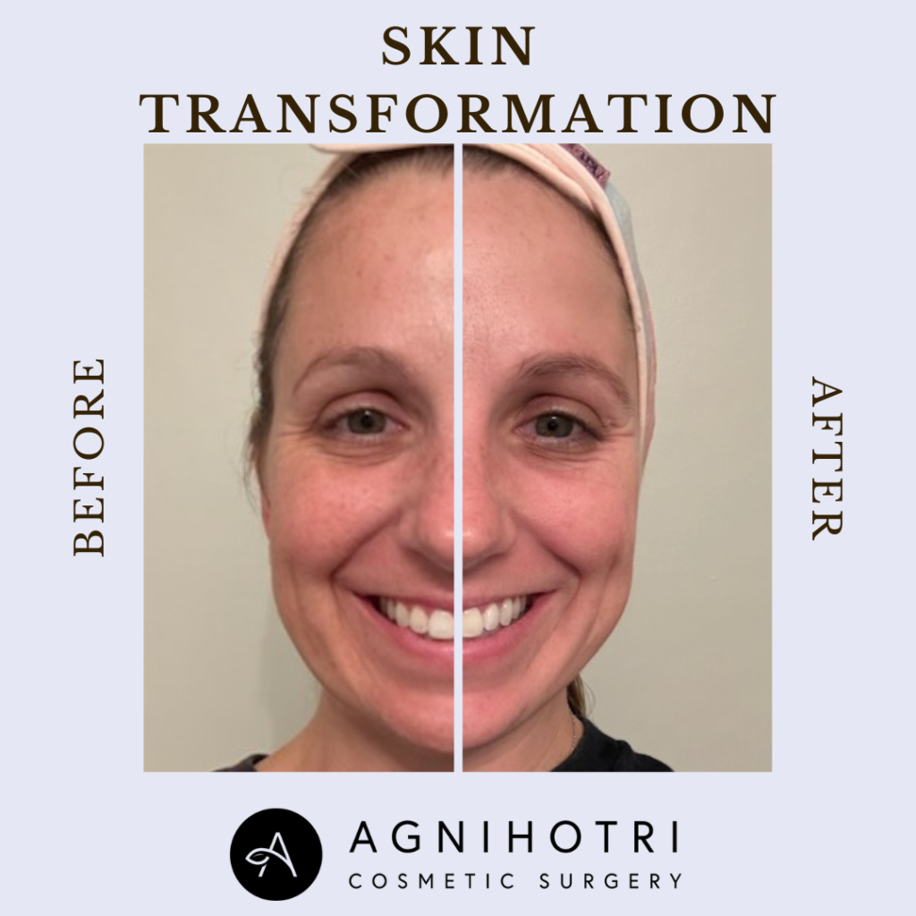 Skin Transformation